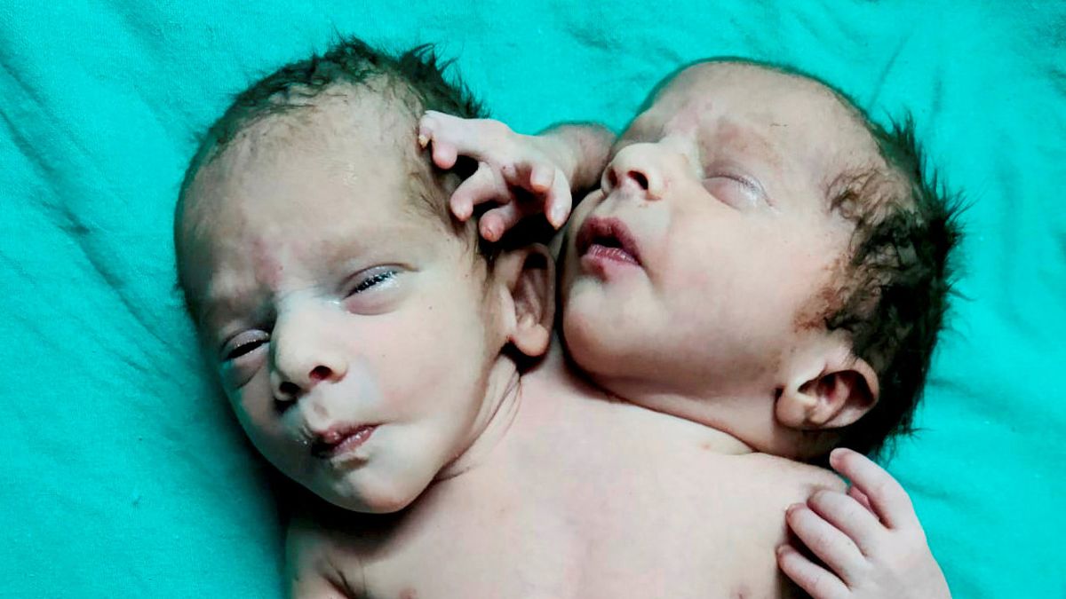 Baby born with three hands, two heads and two hearts after mum told to ...